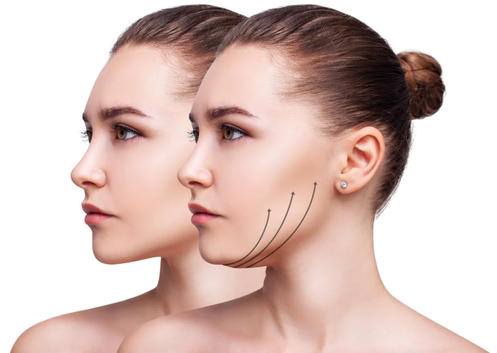 Kybella Treatment for Double Chin: A Comprehensive Guide
